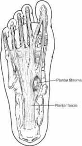 Plantar Fibroma - Advance Foot Clinic Podiatry