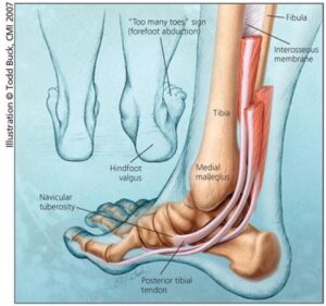 Posterior Tibial Tendon Dysfunction - Advance Foot Clinic Podiatry