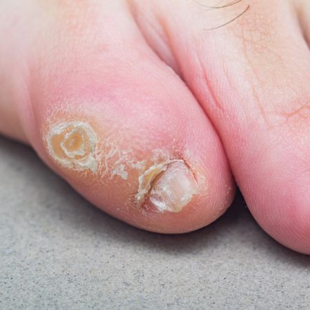 5 Skin conditions podiatrists treat - Advance Foot Clinic Podiatry
