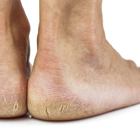 5 Skin conditions podiatrists treat - Advance Foot Clinic Podiatry