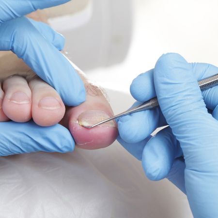 Can my GP fix my ingrown toenail? - Advance Foot Clinic Podiatry