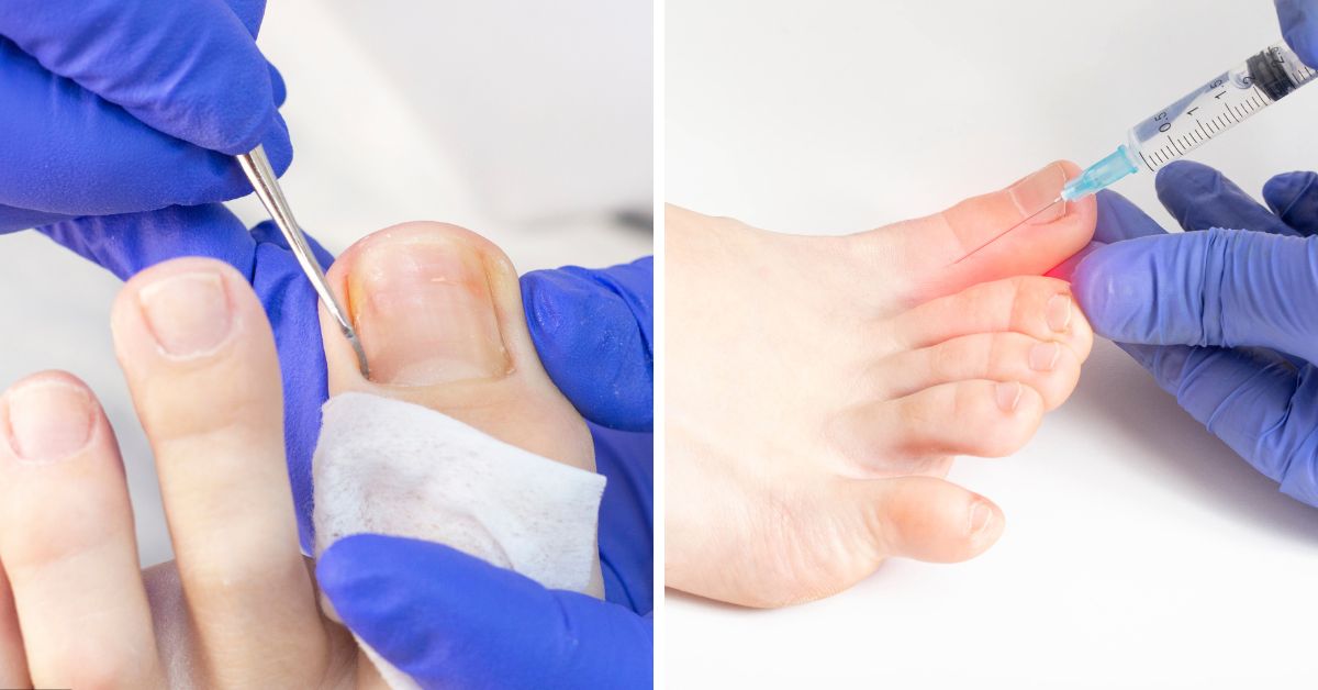 Do Nail Salons Treat Ingrown Toenails at Naomi Marshall blog