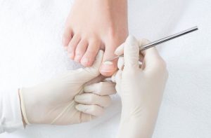 Onyfix Nail Brace for Ingrown Nails - Advance Foot Clinic Podiatry
