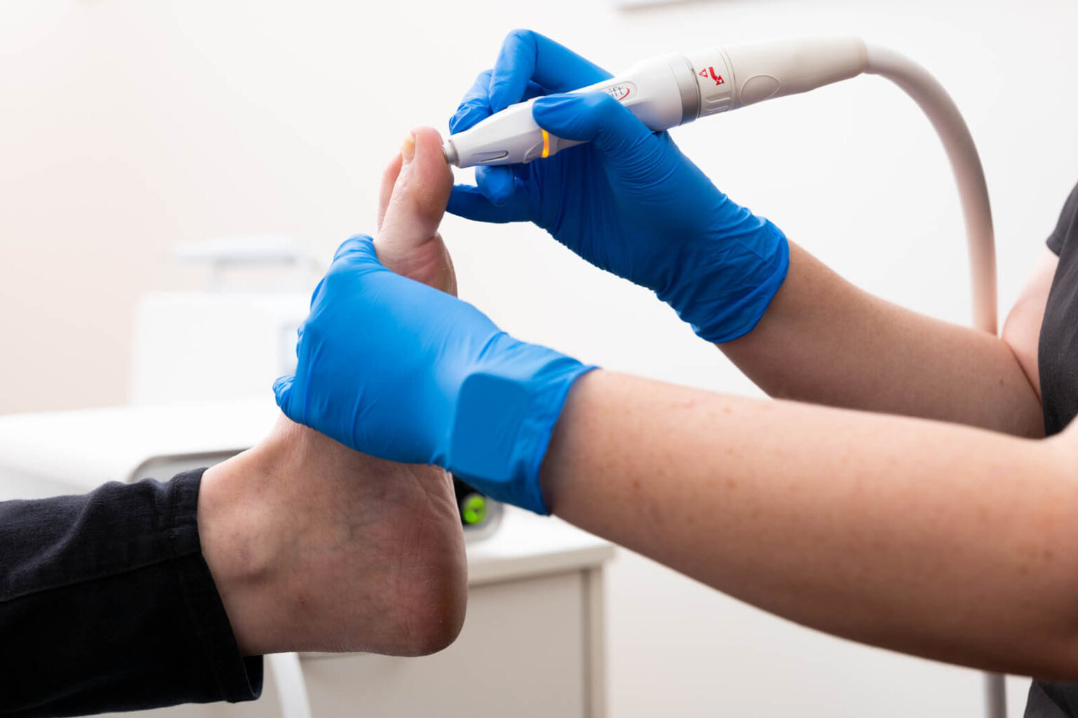 Swift Wart Treatment - Advance Foot Clinic Podiatry