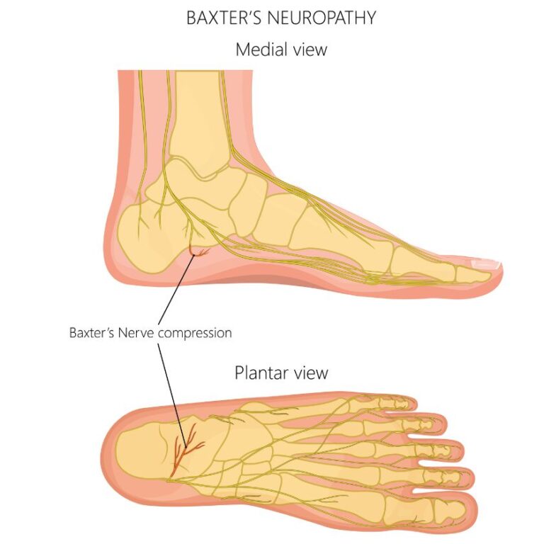 Medial Calcaneal Nerve Entrapment - Advance Foot Clinic