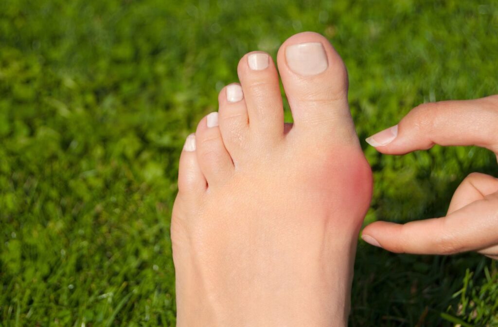 Turf Toe - Advance Foot Clinic Podiatry