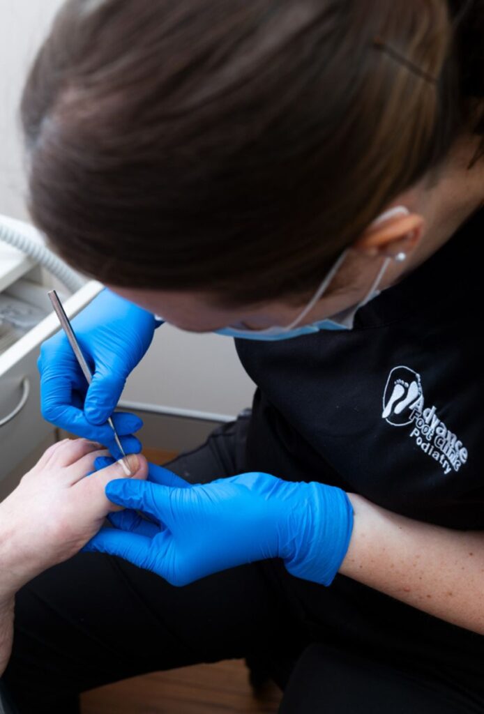 Onyfix Nail Brace for Ingrown Nails - Advance Foot Clinic