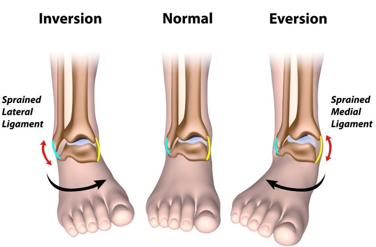 Ankle Sprains - Advance Foot Clinic Podiatry