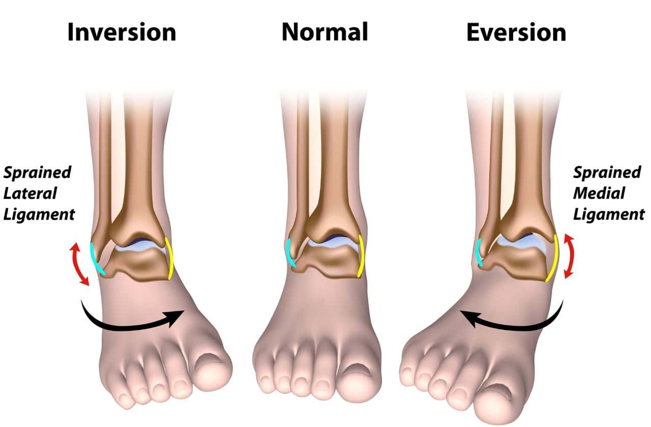 Ankle Sprains - Advance Foot Clinic Podiatry