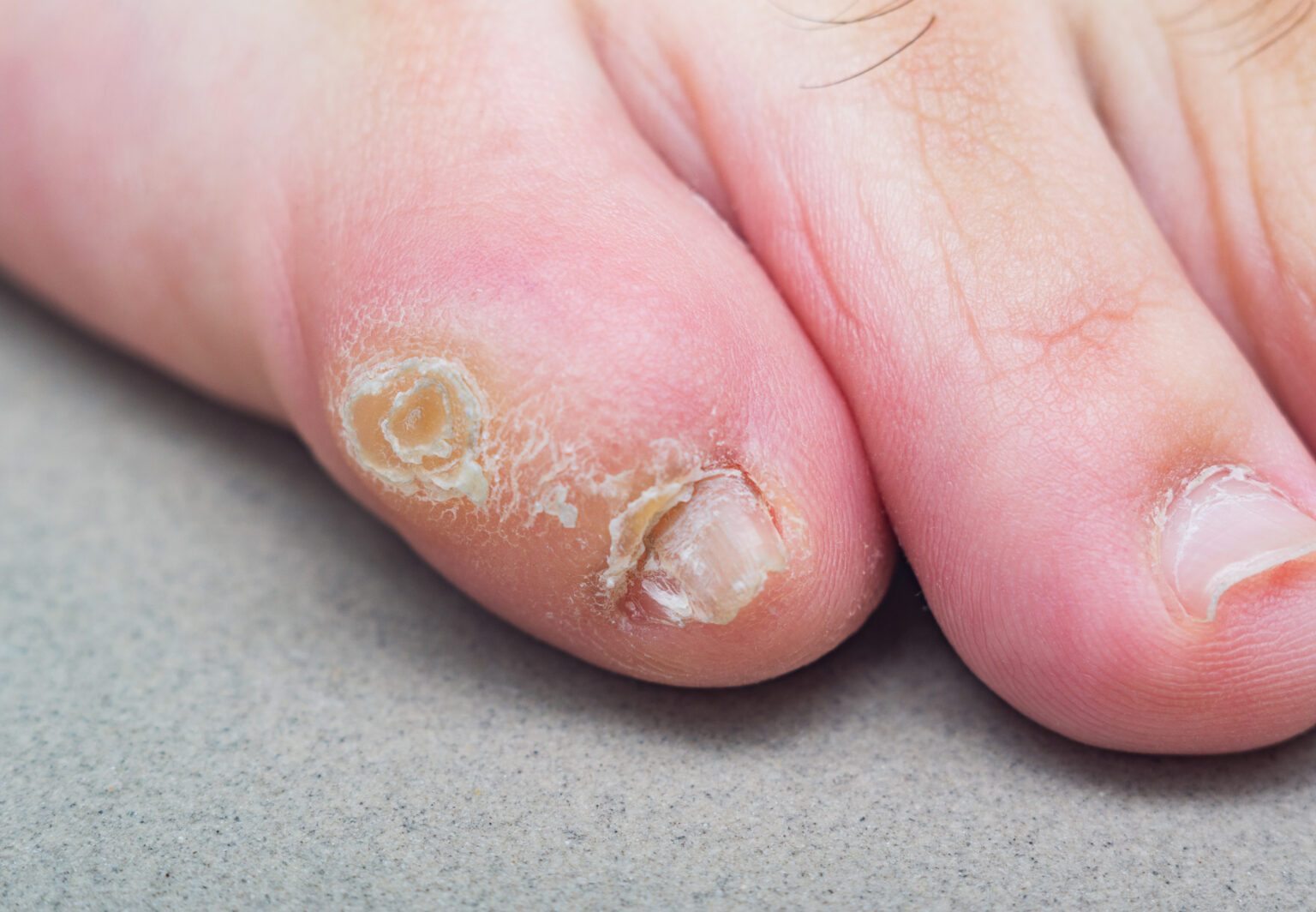 Treatment for Corns: Your Guide - Advance Foot Clinic Podiatry
