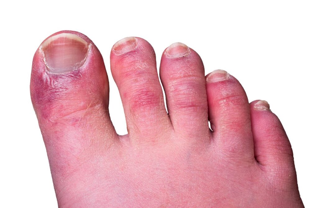 Raynaud’s Phenomenon - Advance Foot Clinic Podiatry